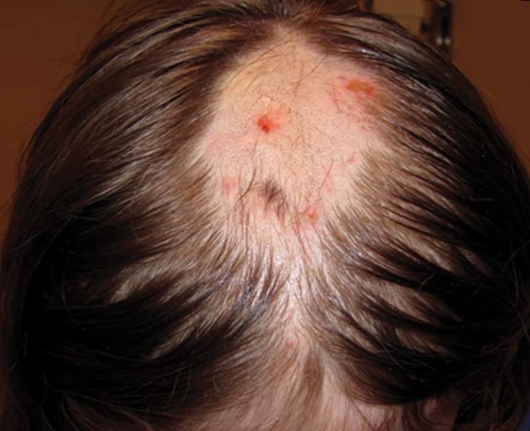 Why is My Scalp Tender In One Spot : Know How To Cure It
